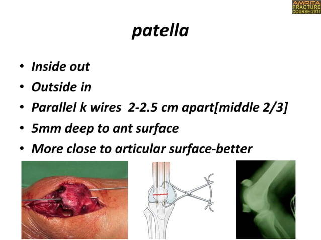 Tension band wiring and plating of fractures- dr mohamed ashraf.govt TD ...