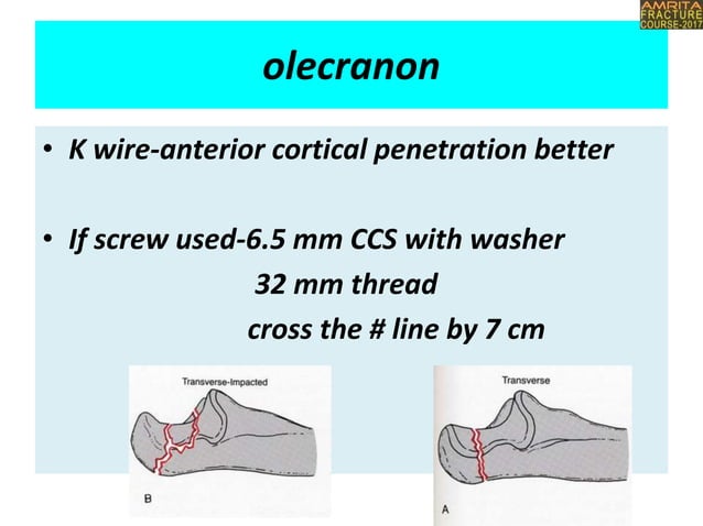 Tension band wiring and plating of fractures- dr mohamed ashraf.govt TD ...