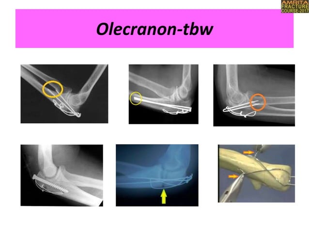 Tension band wiring and plating of fractures- dr mohamed ashraf.govt TD ...