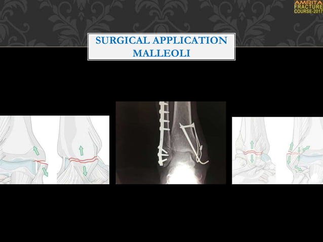 Tension band wiring and plating of fractures- dr mohamed ashraf.govt TD ...