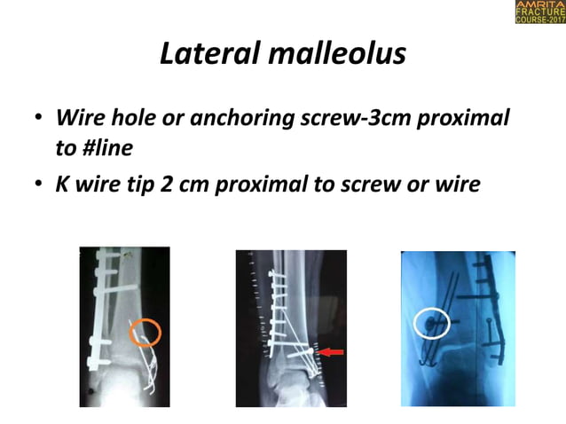 Tension band wiring and plating of fractures- dr mohamed ashraf.govt TD ...