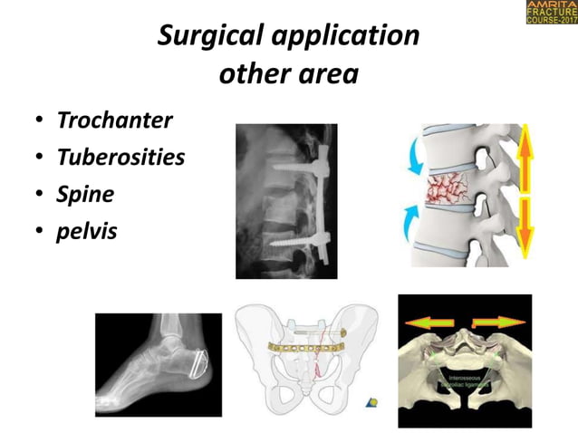 Tension band wiring and plating of fractures- dr mohamed ashraf.govt TD ...