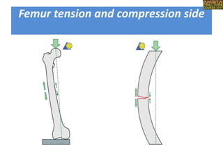 Tension band wiring and plating of fractures- dr mohamed ashraf.govt TD ...