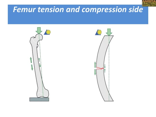 Tension band wiring and plating of fractures- dr mohamed ashraf.govt TD ...