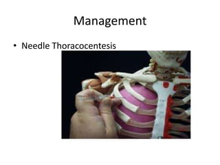 tension pneumothorax.pptx