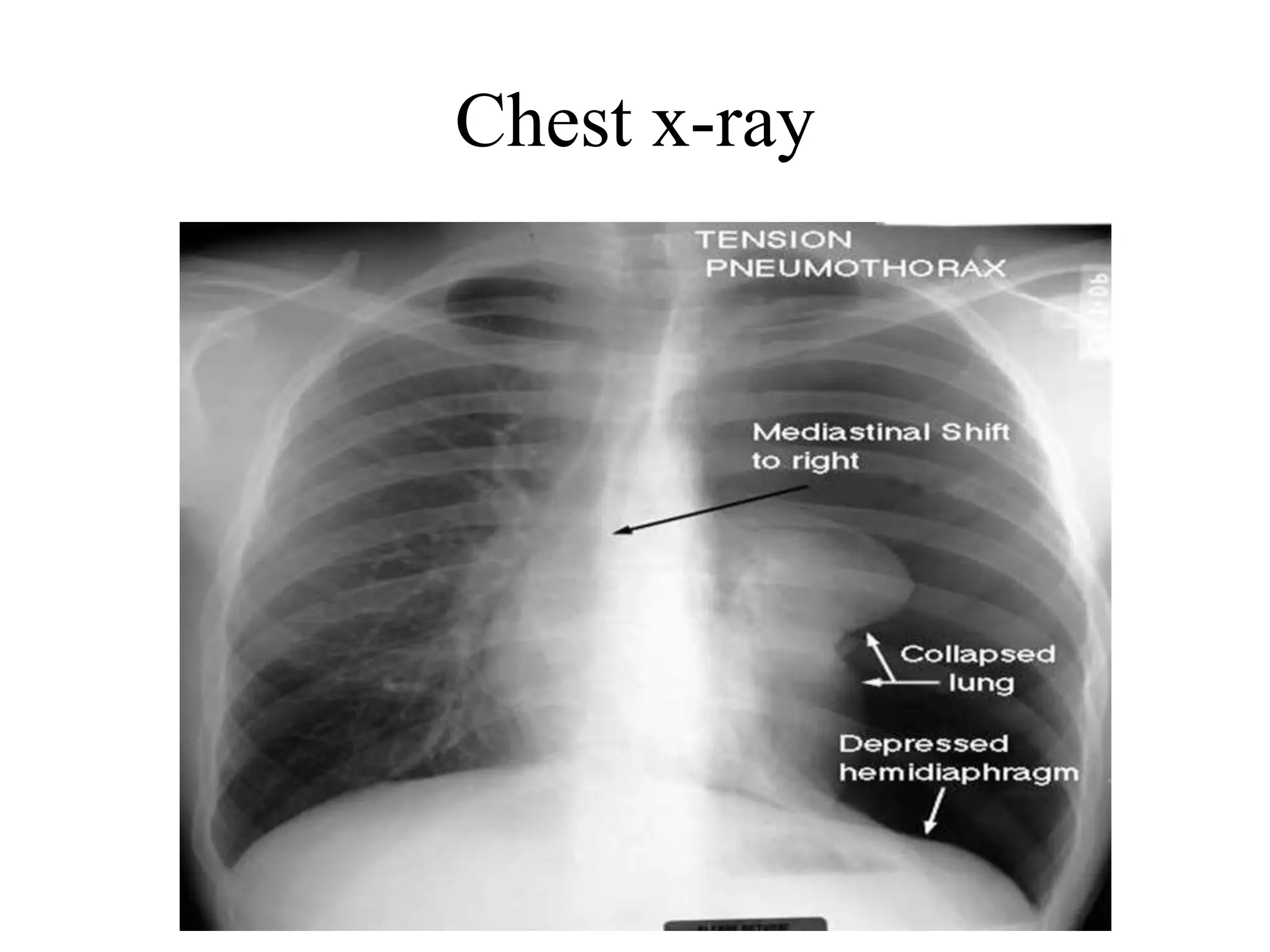 Tension Pneumothorax And Chest Trauma pptx | PPTX