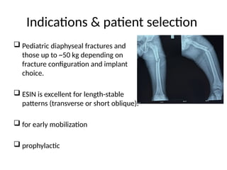 tens nail principles and indications ppt | PPTX