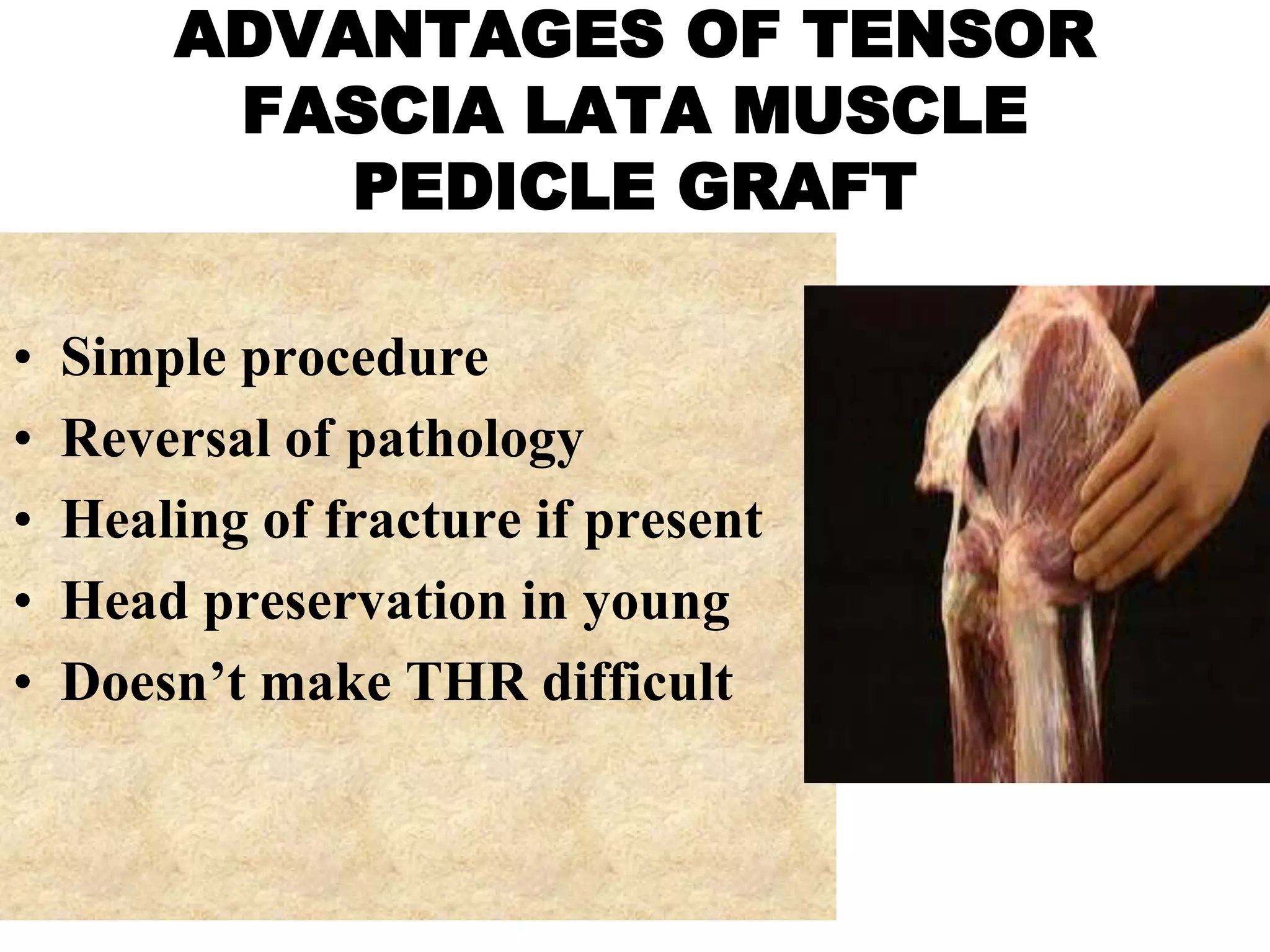Tensor fascia lata[tfl] muscle pedicle grafting for avn hip dr mohamed ...