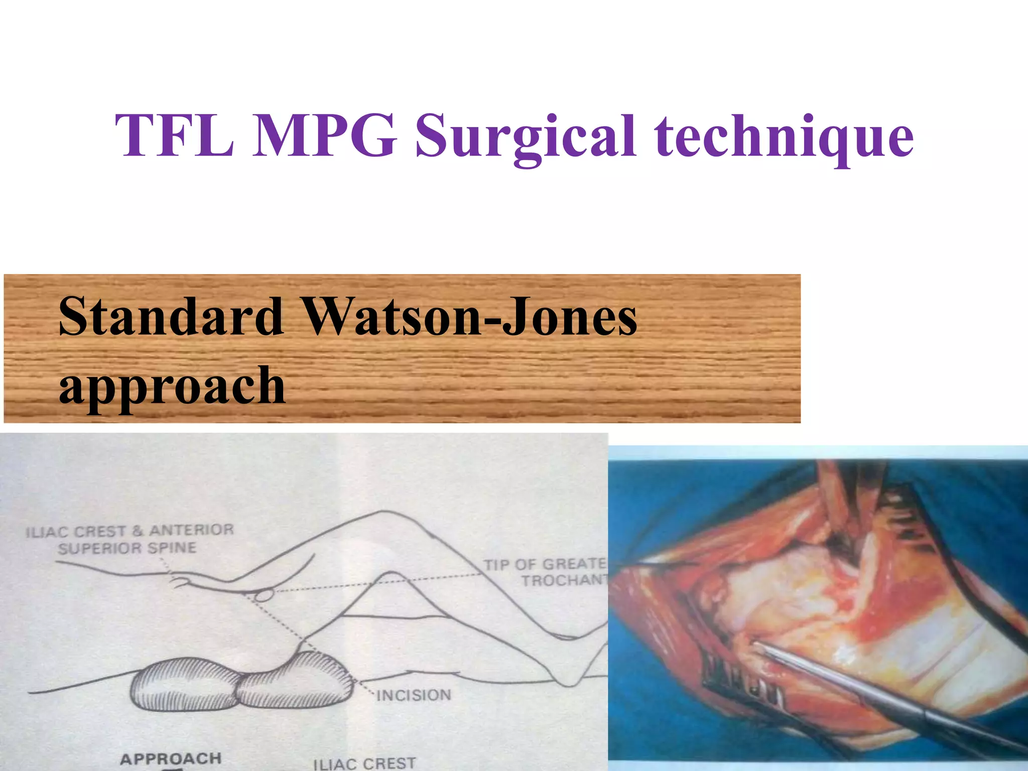 Tensor fascia lata[tfl] muscle pedicle grafting for avn hip dr mohamed ...