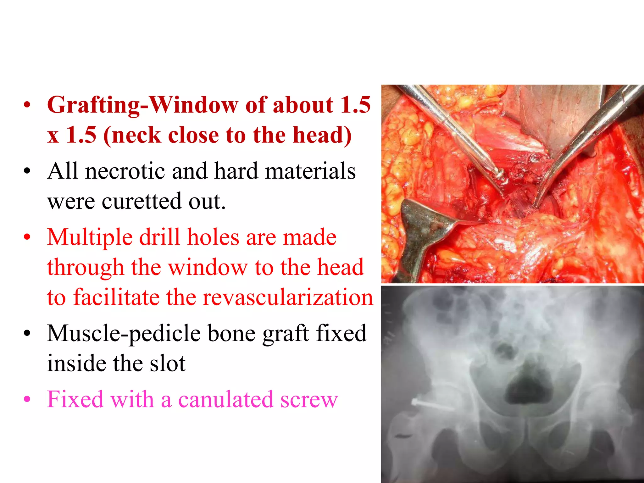 Tensor fascia lata[tfl] muscle pedicle grafting for avn hip dr mohamed ...