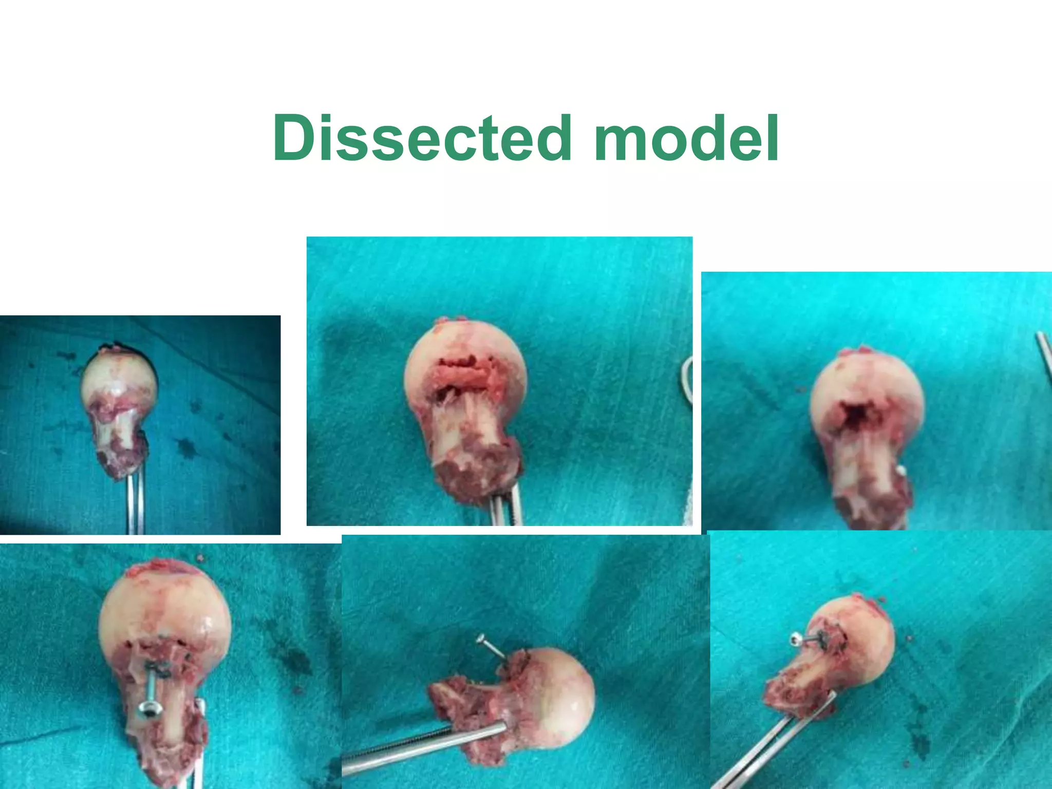 Tensor fascia lata[tfl] muscle pedicle grafting for avn hip dr mohamed ...