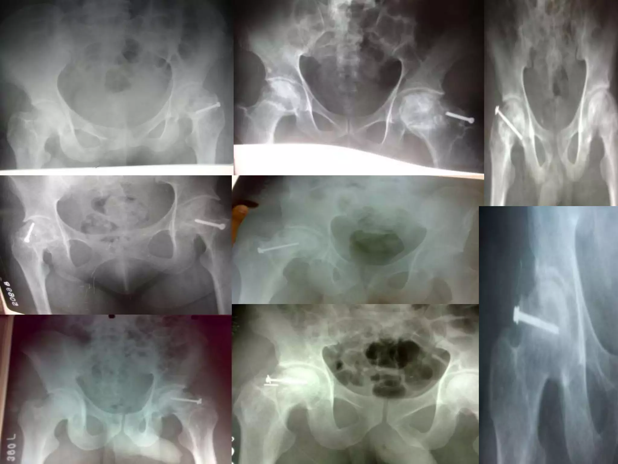 Tensor fascia lata[tfl] muscle pedicle grafting for avn hip dr mohamed ...