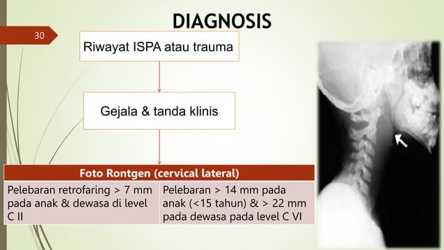 Tentiran Abses Leher Dalam yogi.pptx