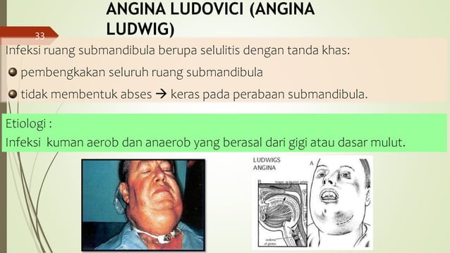 Tentiran Abses Leher Dalam yogi.pptx