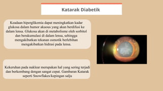 Tentiran Anatomi dan Kelainan Lensa.pptx