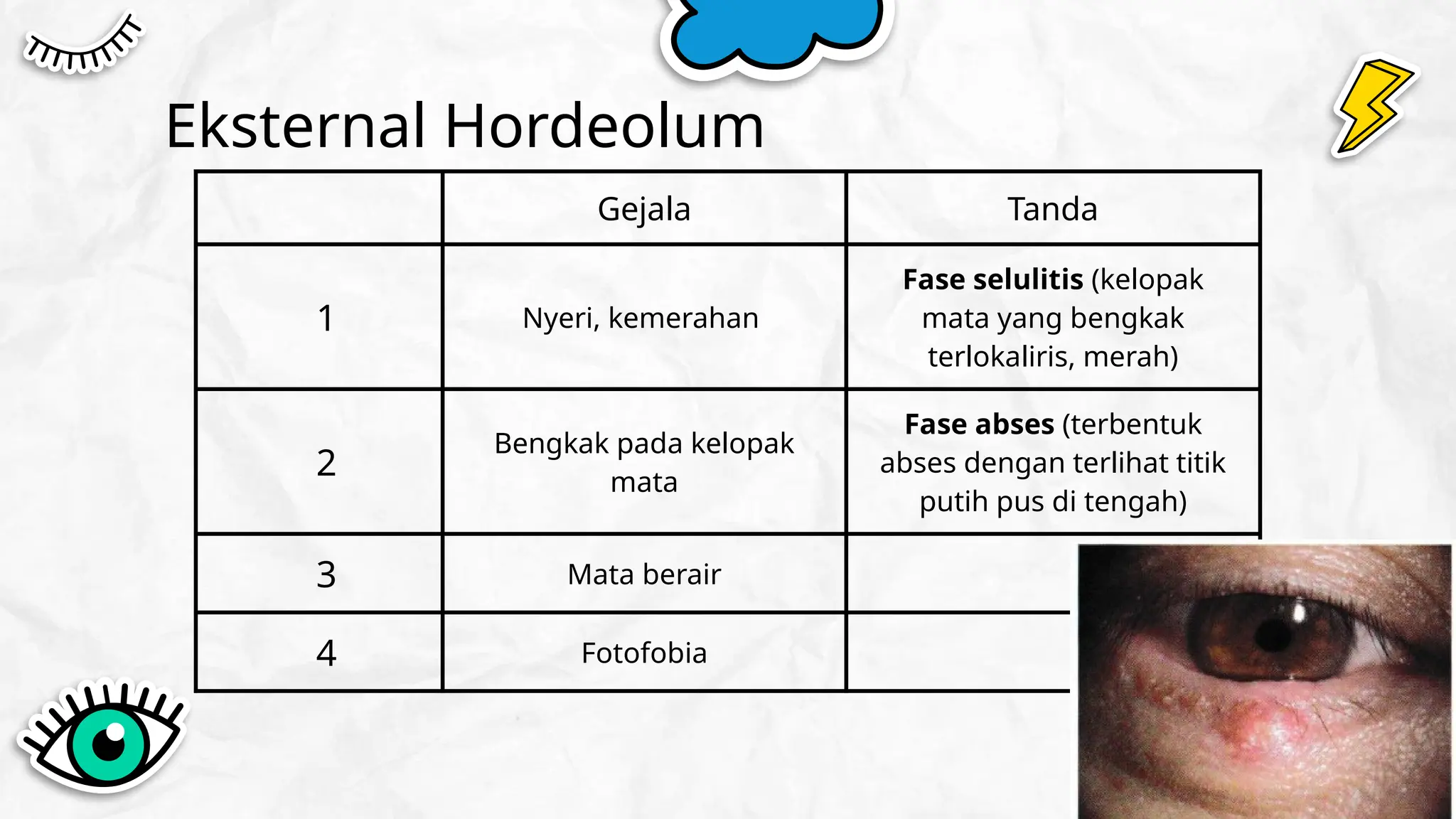 Tentiran PPT Anatomi dan Penyakit Palpebra.pptx