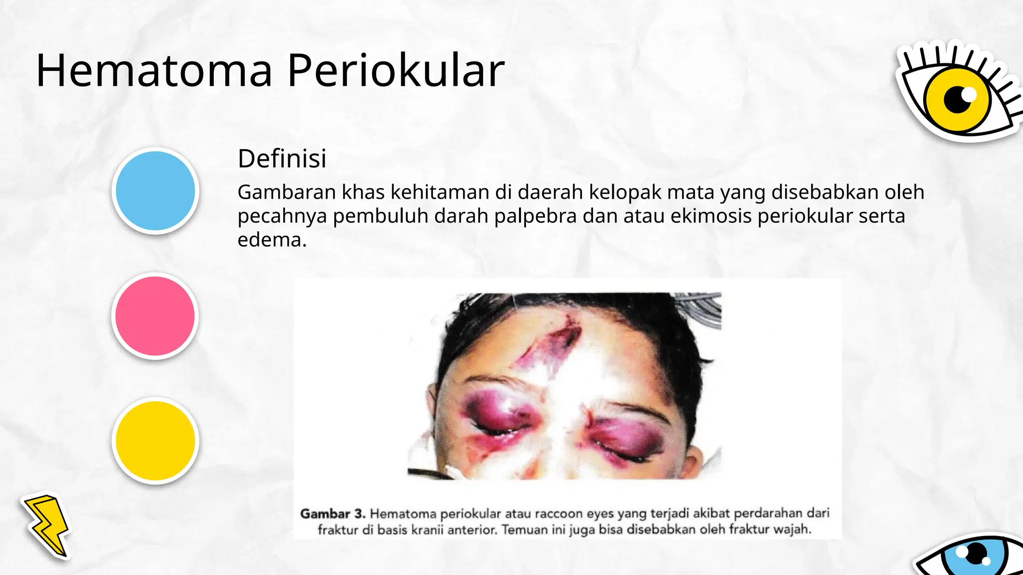 Tentiran PPT Anatomi dan Penyakit Palpebra.pptx