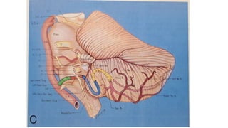 anatomical points about tentorial incisura | PDF