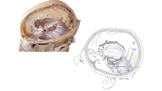 anatomical points about tentorial incisura | PDF