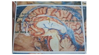 anatomical points about tentorial incisura | PDF