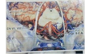 anatomical points about tentorial incisura | PDF