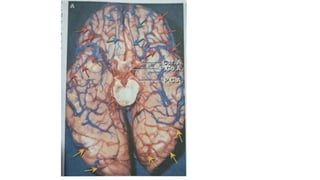 anatomical points about tentorial incisura | PDF