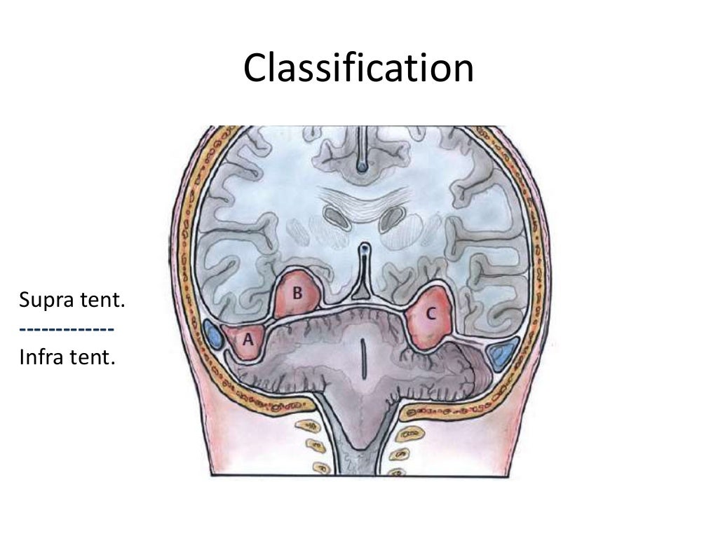 Tentorial meningiomas