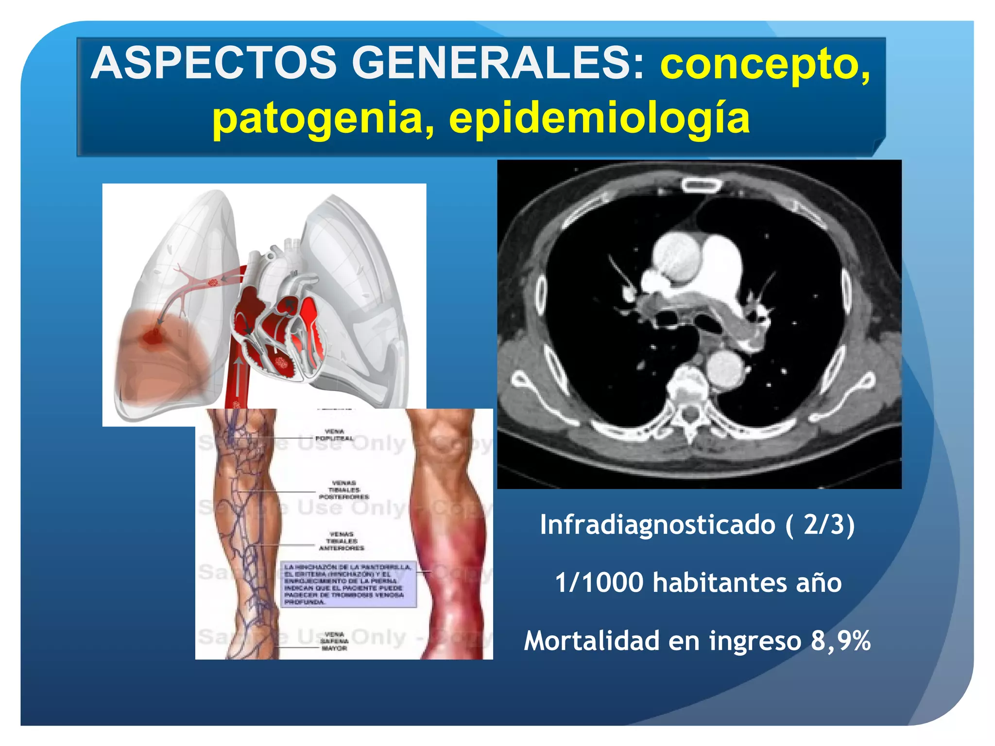 TEP - Tromboembolismo Pulmonar Agudo | PPT