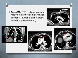Tromboembolismo Pulmonar. Manejo en Urgencias | PDF