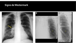 TROMBOEMBOLIA PULMONAR | PPT