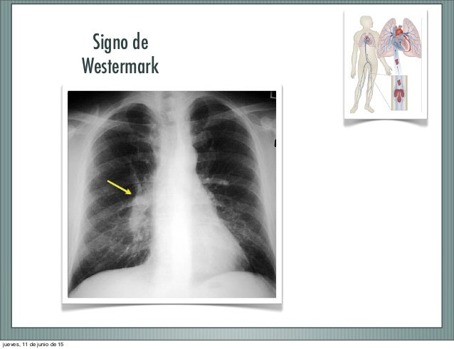 Tromboembolismo Pulmonar 2015