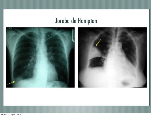 Tromboembolismo Pulmonar 2015
