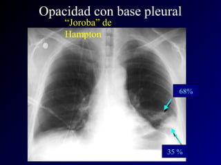TROMBOEMBOLIA PULMONAR 30 XI 2014 | PPT