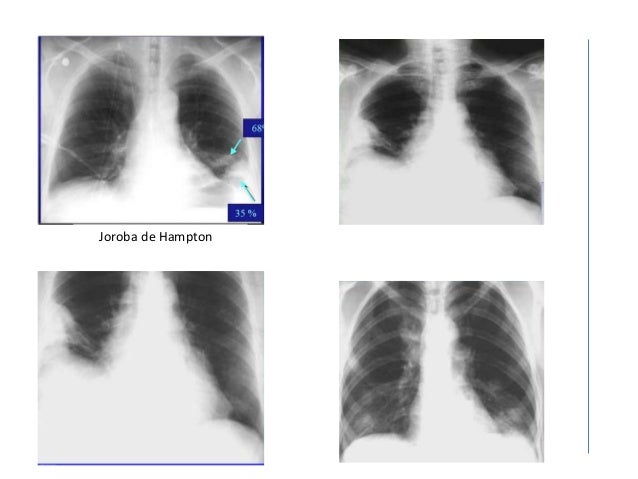 Trombo Embolismo Pulmonar