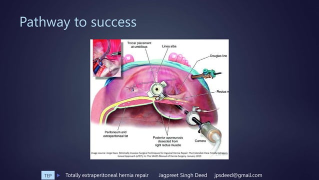 TEP Totally extraperitoneal inguinal hernia repair.pptx | Death, Injury ...