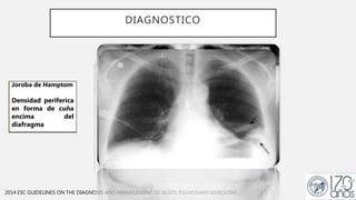 Tromboembolia Pulmonar | PPTX