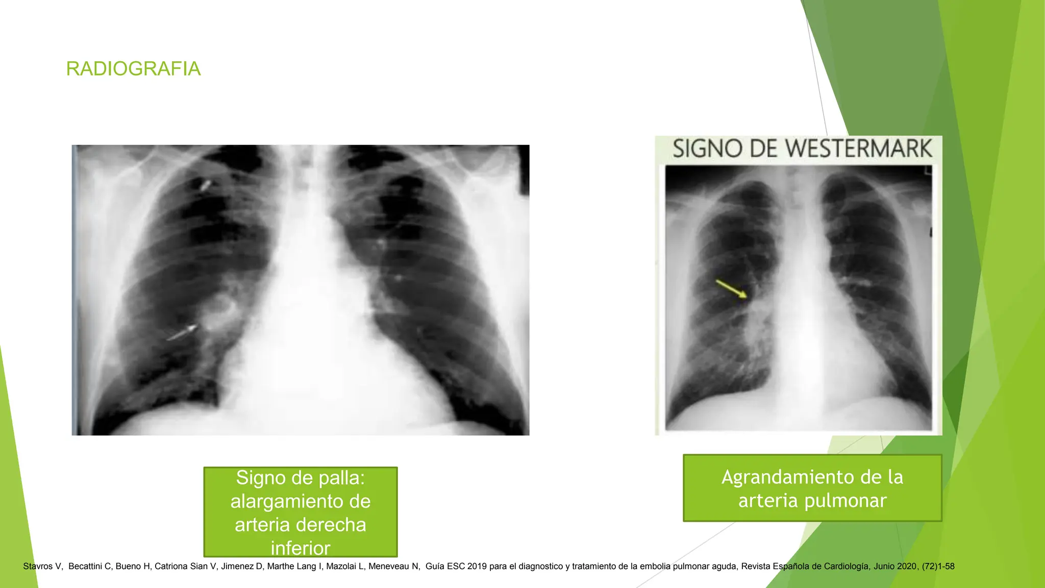 TEP PRESENTACION AGRECACION DE CASCADA DE COAGULACION.pptx