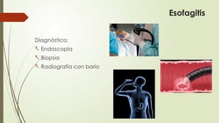 Tera Esofagitis, hernia hiatal, gastritis aguda y crónica, úlcera ...