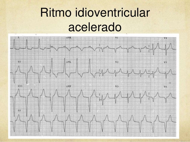 Terapia de reperfusión IAM