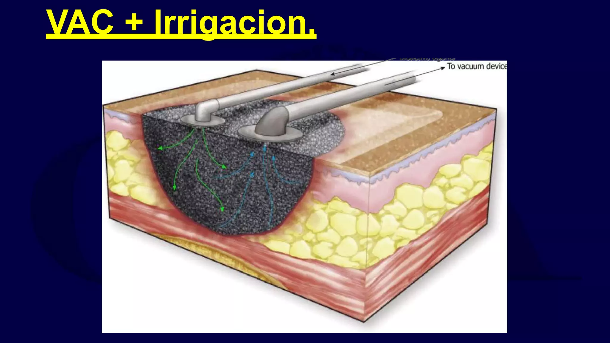 Terapia VAC.pptx