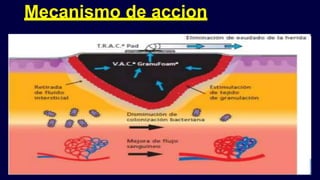 Terapia VAC.pptx