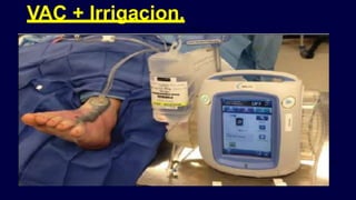 Terapia VAC.pptx