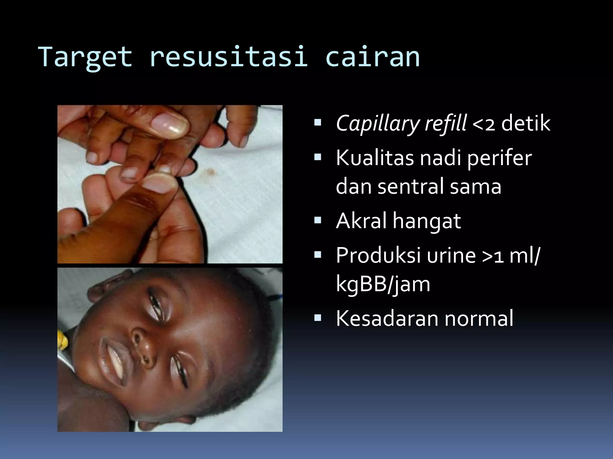 Terapi cairan pada anak | PPTX