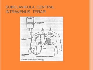 Terapi intravena | PPTX