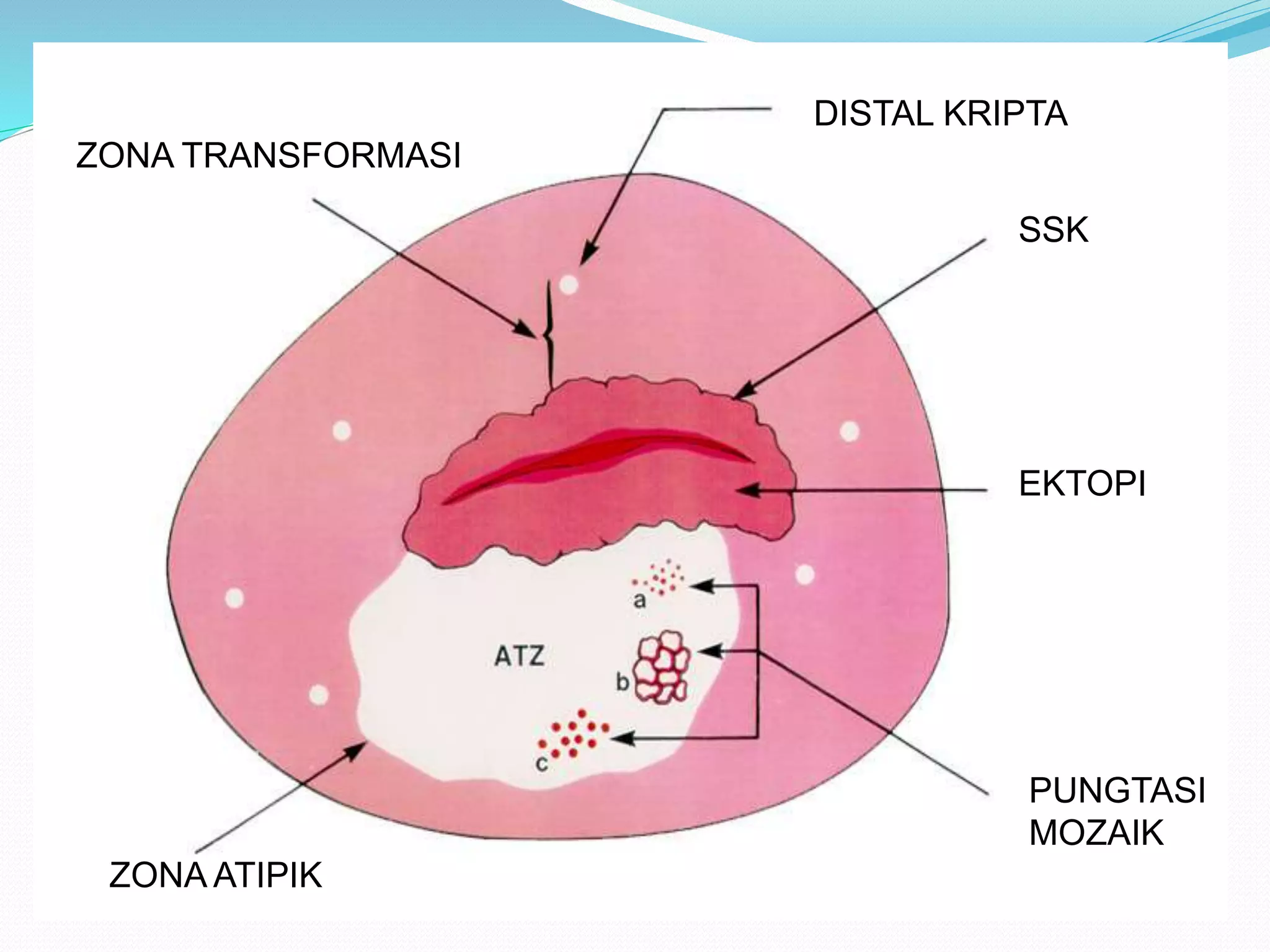 Terapi Lesi prakanker (Krioterapi).pptx