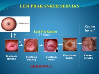 Terapi Lesi prakanker (Krioterapi).pptx