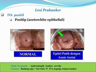 Terapi Lesi prakanker (Krioterapi).pptx
