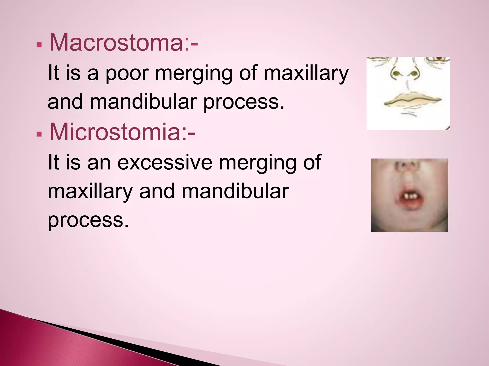Teratogens And Cleft Types | PPTX