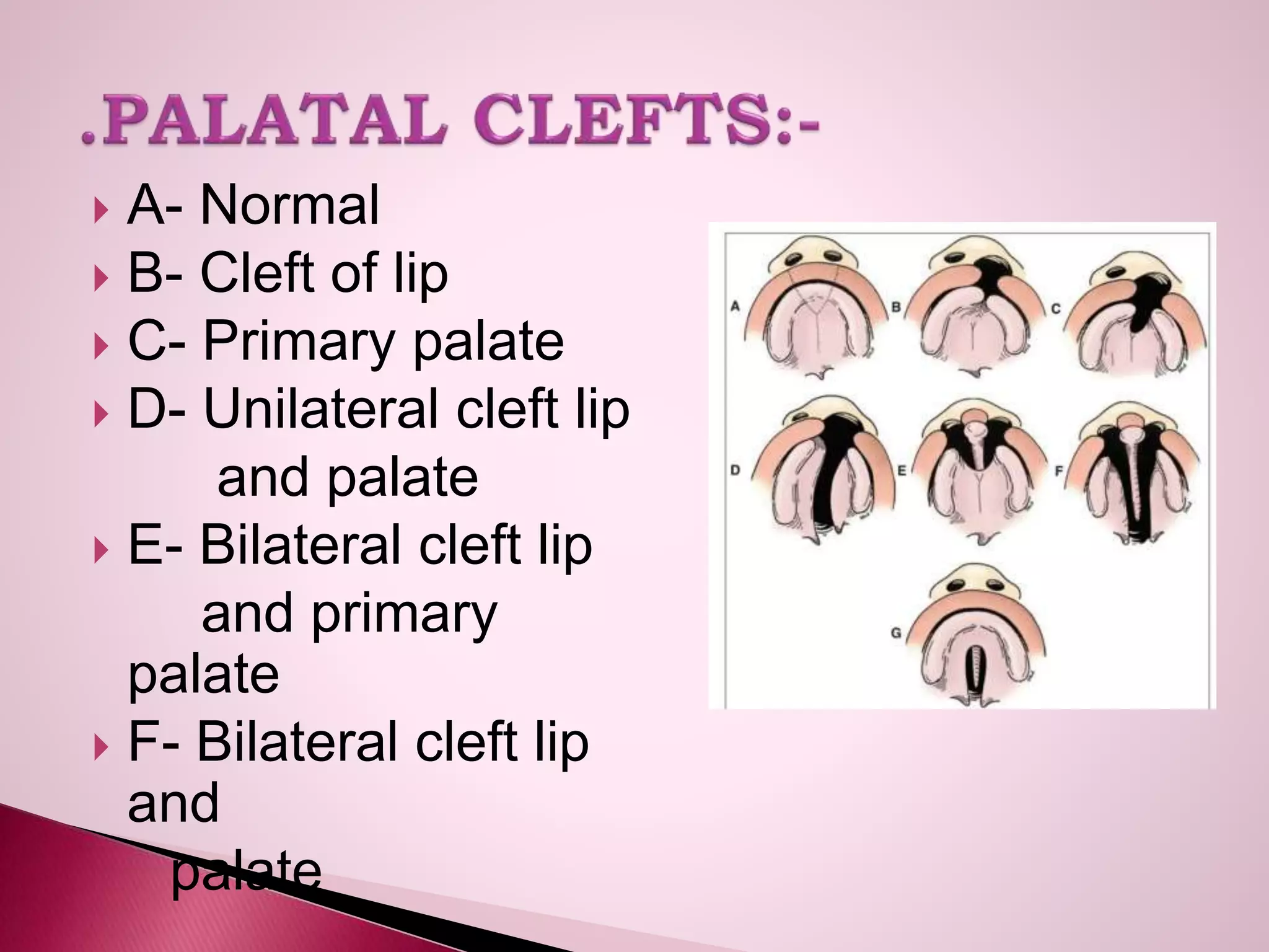 Teratogens And Cleft Types | PPTX