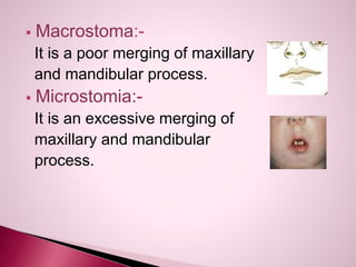 Teratogens And Cleft Types | PPTX
